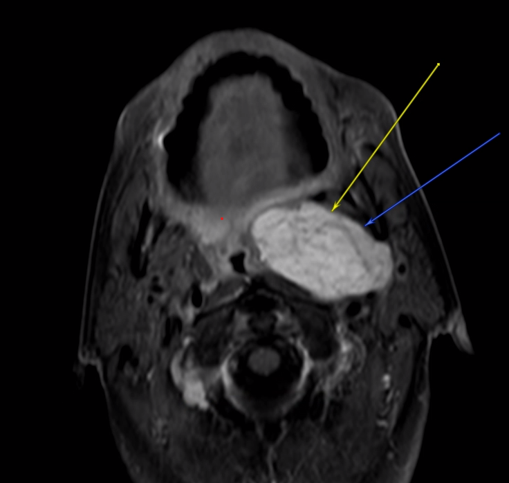 Da Vinci SP robot provides better outcomes for removal of deep lobe tumors
