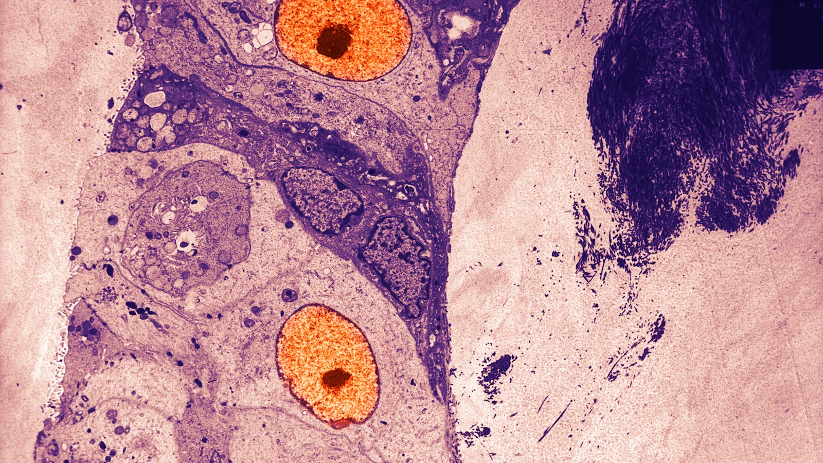 Innovative Therapeutic Strategy Shows Promise for Metaplastic Breast ...